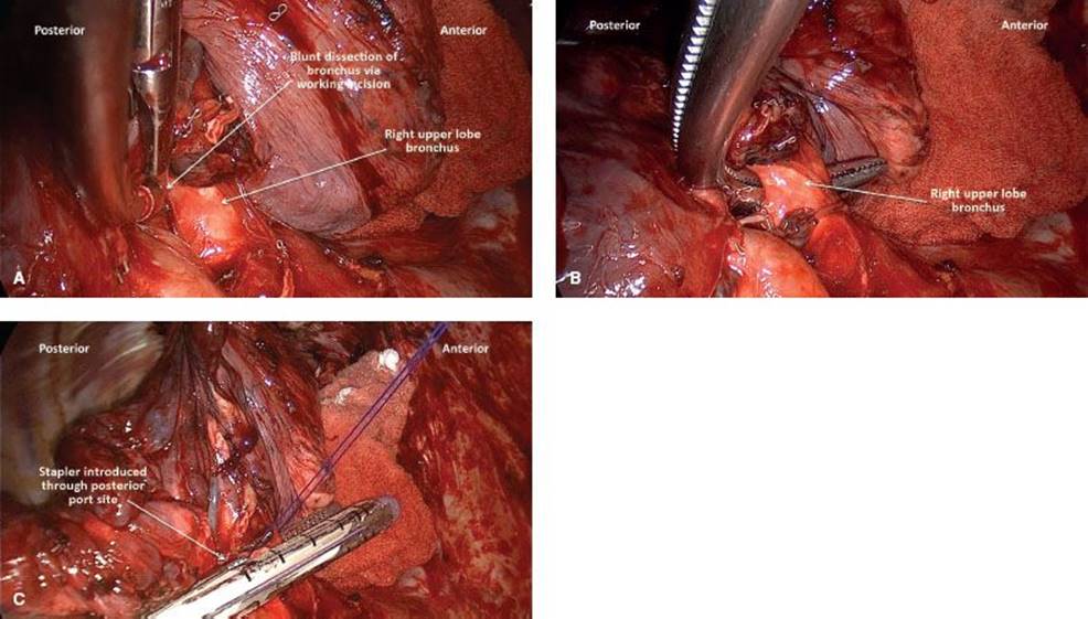 Right Upper Lobe: VATS - Master Techniques in Surgery: Thoracic Surgery ...
