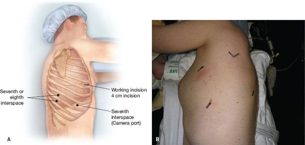 Right Middle Lobe: VATS - Master Techniques in Surgery: Thoracic ...