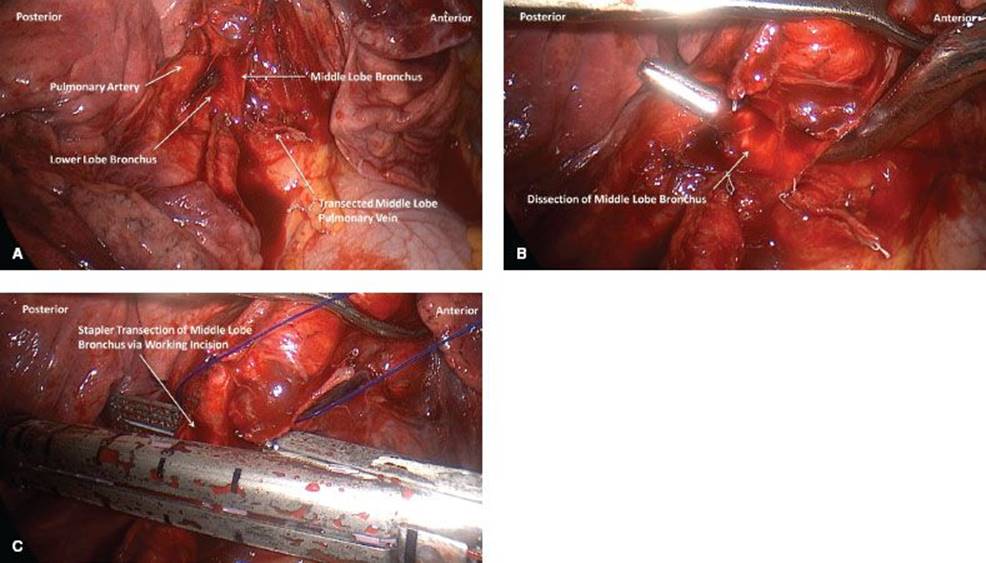 Right Middle Lobe: VATS - Master Techniques in Surgery: Thoracic ...