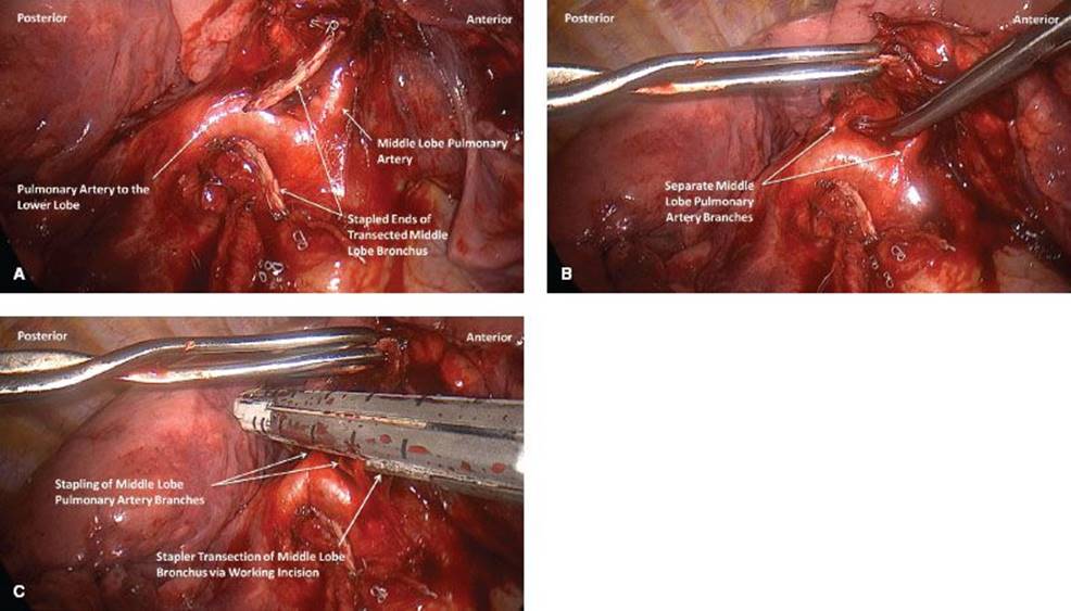Right Middle Lobe: VATS - Master Techniques in Surgery: Thoracic ...