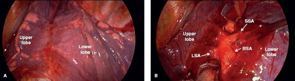 Left Lower Lobectomy: Open - Master Techniques in Surgery: Thoracic ...