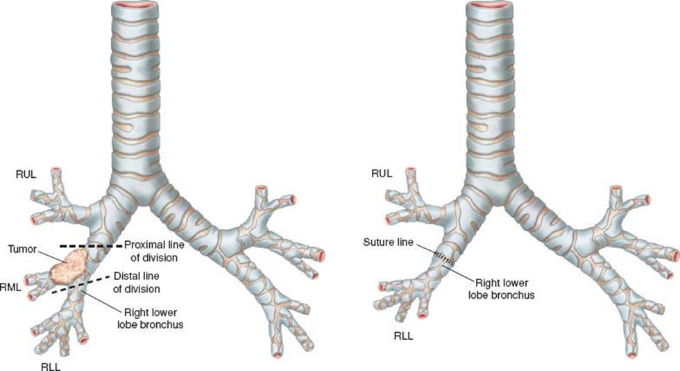 Right Middle Lobe Sleeve Resection - Master Techniques in Surgery ...