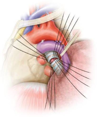 Left Upper Sleeve Lobectomy - Master Techniques in Surgery: Thoracic ...