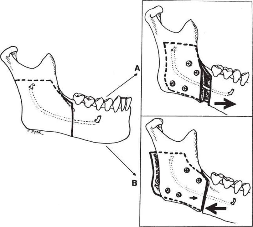 Orthognathic Surgery - Michigan Manual of Plastic Surgery (Lippincott ...