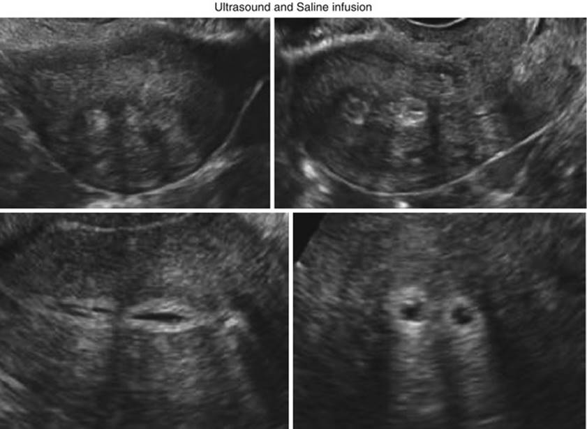 Asherman Syndrome - Minimally Invasive Gynecological Surgery