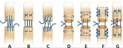 Repair Following Traumatic Extensor Tendon Disruption in the Hand ...