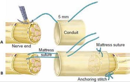 Primary Repair and Nerve Grafting Following Complete Nerve Transection ...