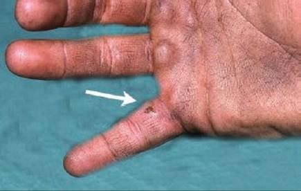 Surgical Treatment of Injection Injuries in the Hand - HAND, WRIST, AND ...