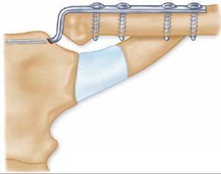 Acute Repair and Reconstruction of Sternoclavicular Dislocation ...