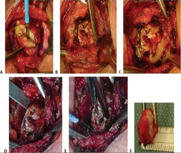 Medial Clavicle Excision and Sternoclavicular Joint Reconstruction ...
