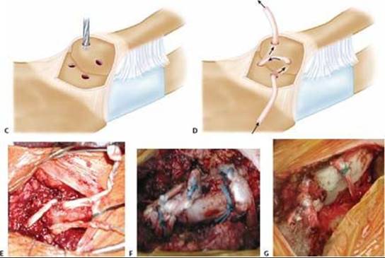 Medial Clavicle Excision and Sternoclavicular Joint Reconstruction ...