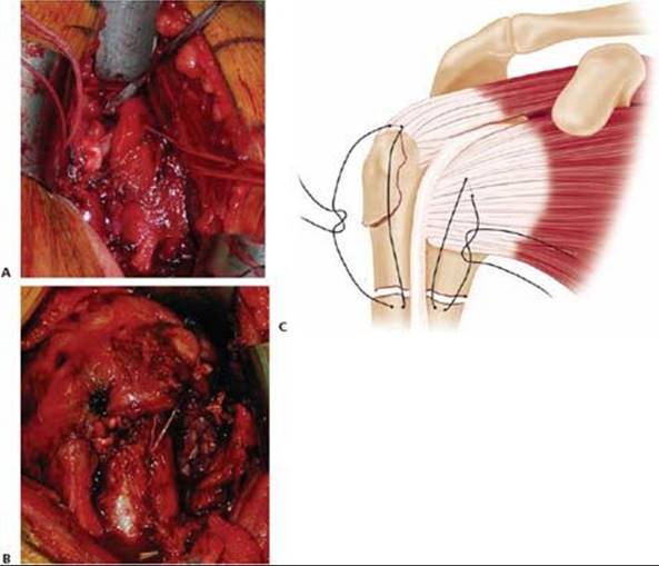 Open Reduction and Internal Fixation of Proximal Humerus Fractures ...