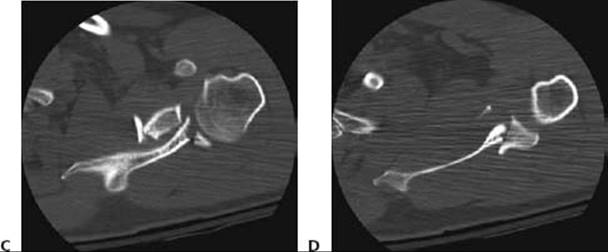 Open Reduction and Internal Fixation of Intra-articular Scapular ...