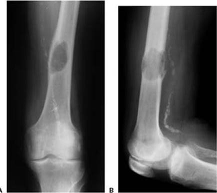 Surgical Management of Metastatic Bone Disease: Femoral Lesions ...