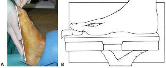 Bone-Block Distraction of the First Metatarsophalangeal Joint - FOOT ...