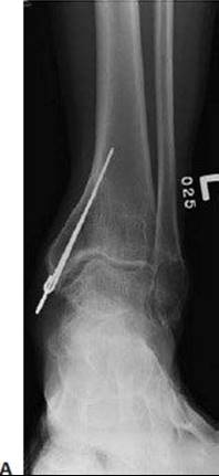 Supramalleolar Osteotomy With External Fixation: Perspective 1 - FOOT ...
