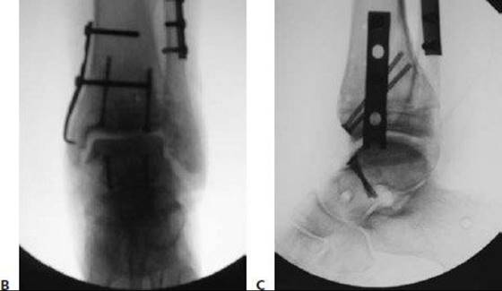 Total Ankle Shell Allograft Reconstruction - FOOT AND ANKLE - Operative ...