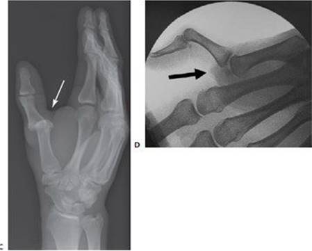 Dislocations and Chronic Volar Instability of the Thumb ...