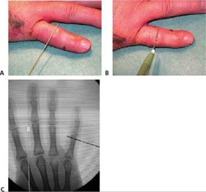 Dynamic External Fixation of Proximal Interphalangeal Joint Fracture ...