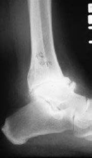 Arthroscopic Ankle Arthrodesis - FOOT AND ANKLE - Operative Techniques ...
