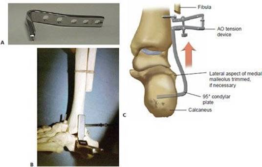 Tibiocalcaneal Arthrodesis Using Blade Plate Fixation - FOOT AND ANKLE ...