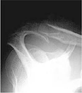 Arthroscopic Treatment of Subacromial Impingement - SPORTS MEDICINE ...