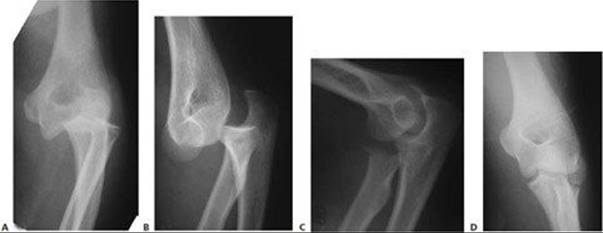 Percutaneous Joystick and Intramedullary Reduction (Metaizeau ...