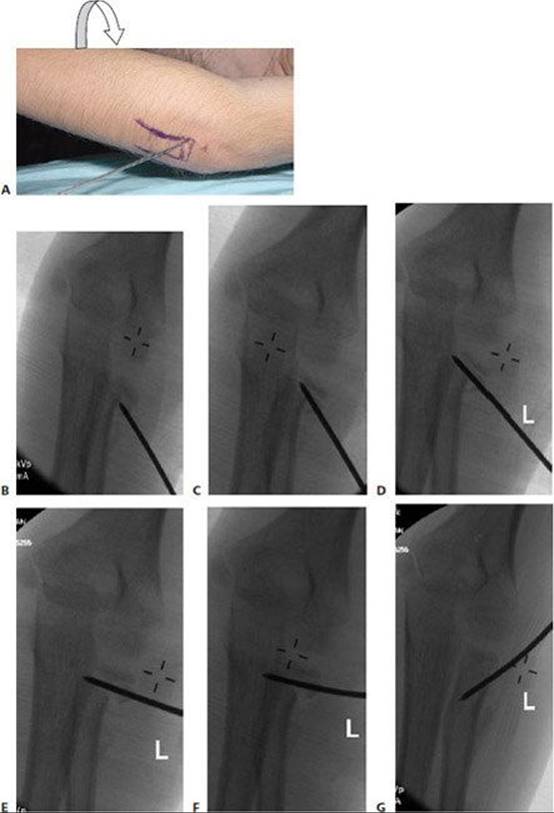 Percutaneous Joystick and Intramedullary Reduction (Metaizeau ...