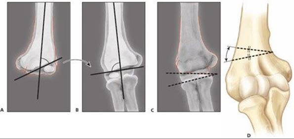 Supracondylar Humeral Osteotomy for Correction of Cubitus Varus ...
