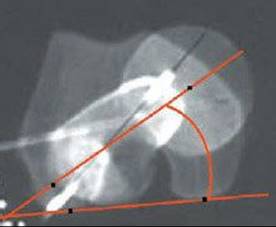 Proximal Femoral Rotational Osteotomy - PEDIATRICS - Operative ...