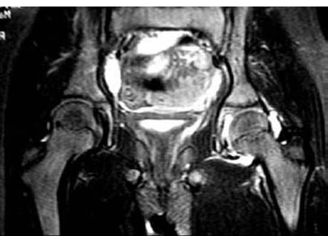 Labral Support (Shelf) Procedure for Perthes Disease - PEDIATRICS ...