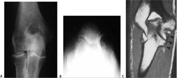Arthroscopic Treatmentof Valgus Extension Overload - SPORTS MEDICINE ...