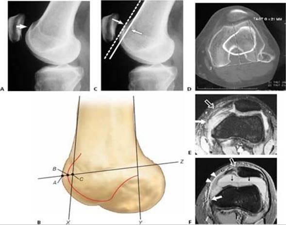 Proximal Realignment of the Medial Patellofemoral Ligament - SPORTS ...