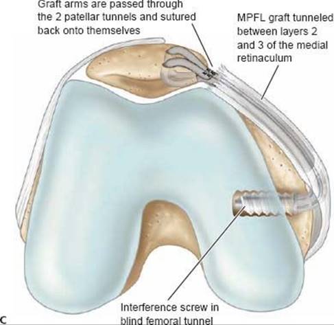 Proximal Realignment of the Medial Patellofemoral Ligament - SPORTS ...