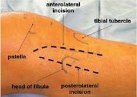 Lateral Tibial Plateau Fractures - PELVIS AND LOWER EXTREMITY TRAUMA ...