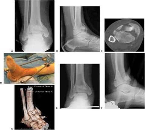 Open Reduction and Internal Fixation of the Pilon - PELVIS AND LOWER ...