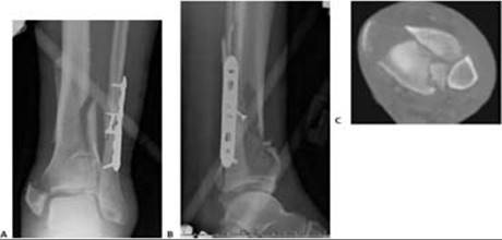 Open Reduction and Internal Fixation of the Pilon - PELVIS AND LOWER ...