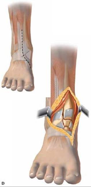 Open Reduction and Internal Fixation of the Pilon - PELVIS AND LOWER ...