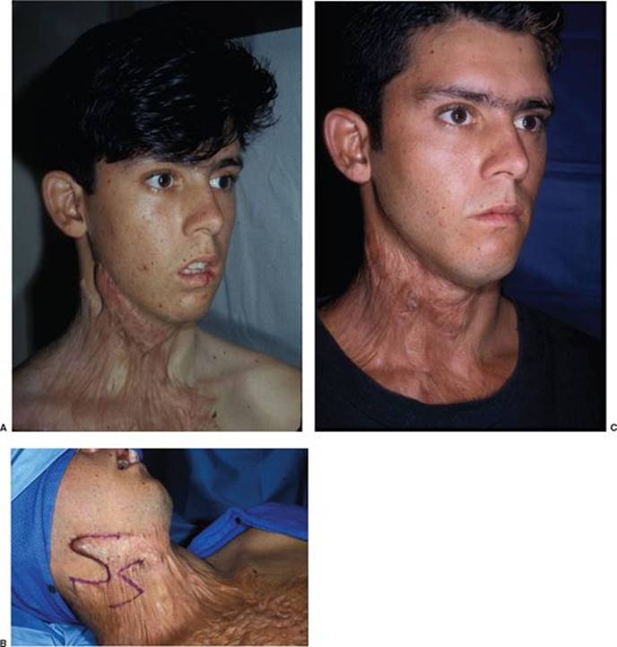 PRINCIPLES OF BURN RECONSTRUCTION - Grabb and Smith's Plastic Surgery ...