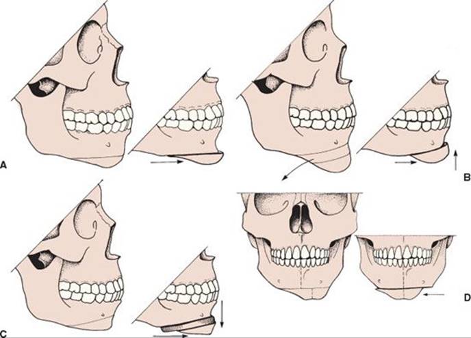 OSSEOUS GENIOPLASTY - Grabb and Smith's Plastic Surgery (GRABB'S ...