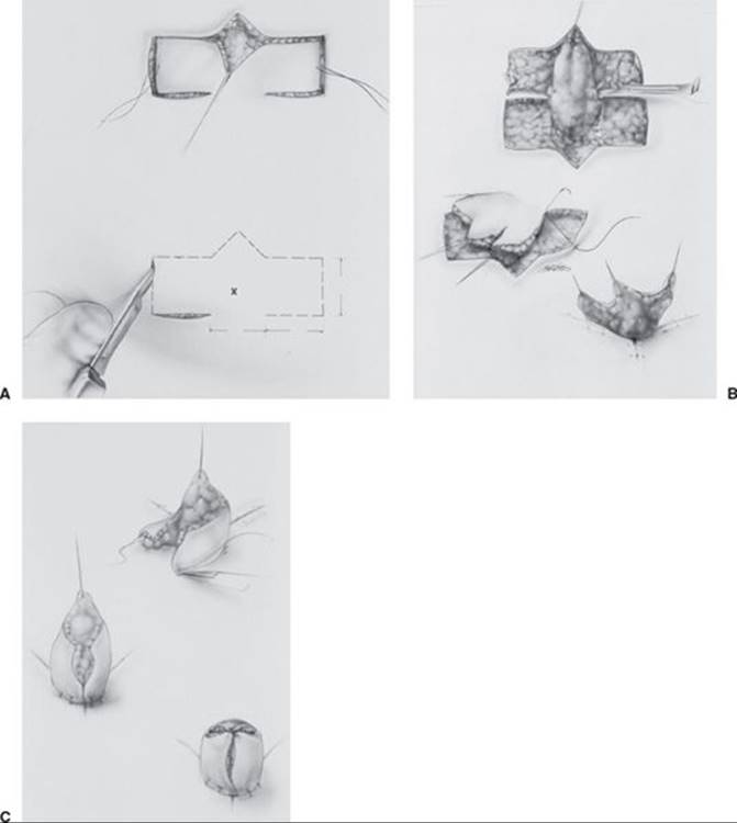 NIPPLE RECONSTRUCTION - Grabb and Smith's Plastic Surgery (GRABB'S ...