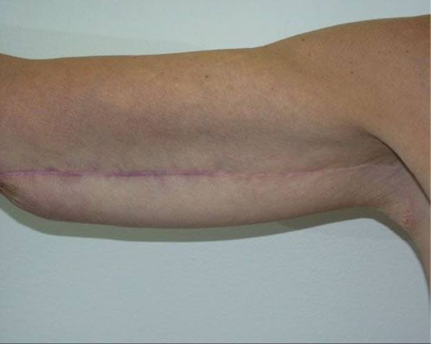 BRACHIOPLASTY AND UPPER TRUNK CONTOURING - Grabb and Smith's Plastic ...