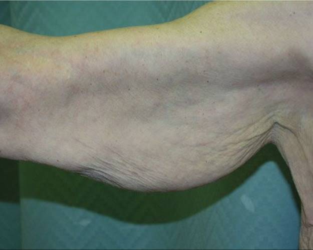 BRACHIOPLASTY AND UPPER TRUNK CONTOURING - Grabb and Smith's Plastic ...