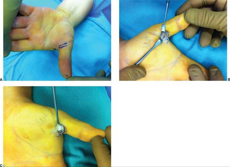 TENOSYNOVITIS DISORDERS OF THE UPPER EXTREMITY - Grabb and Smith's ...