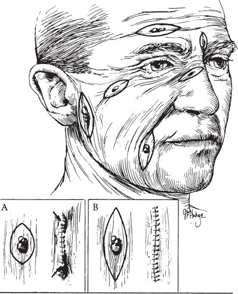 TECHNIQUES AND PRINCIPLES IN PLASTIC SURGERY - Plastic surgery