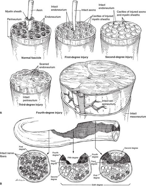 PRINCIPLES AND TECHNIQUES OF PERIPHERAL NERVE REPAIR, GRAFTS, AND ...