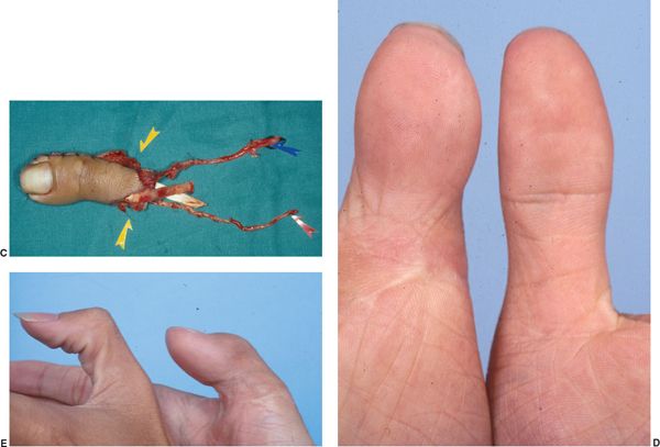 THUMB RECONSTRUCTION - Plastic surgery