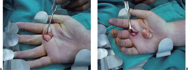 HAND TUMORS - Plastic surgery