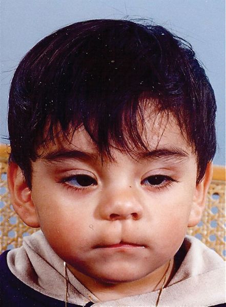 CRANIOFACIAL CLEFTS AND HYPERTELORBITISM - Plastic surgery