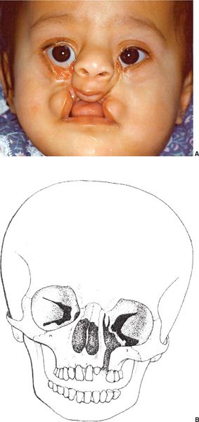 CRANIOFACIAL CLEFTS AND HYPERTELORBITISM - Plastic surgery